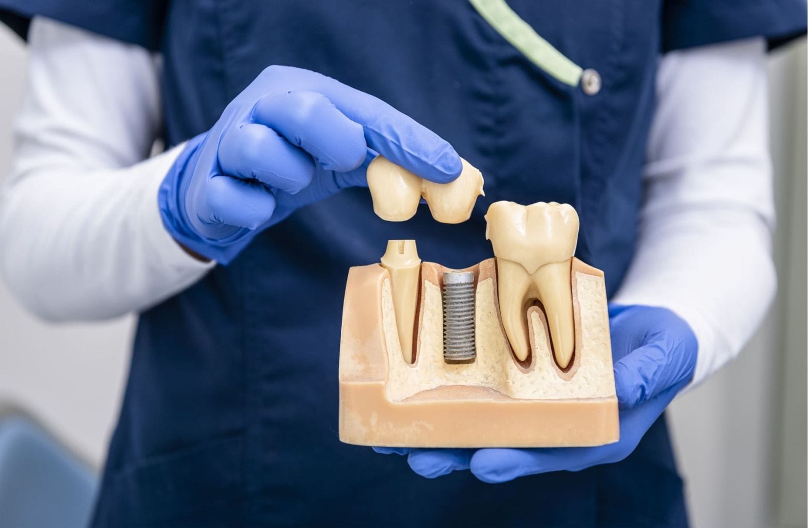 Che Cos'è Un Impianto Dentale | Centro Brunelleschi
